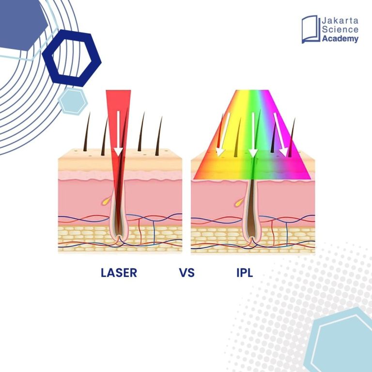 Mengenal Terapi Laser Wajah dengan Metode IPL : Jakarta Science Academy